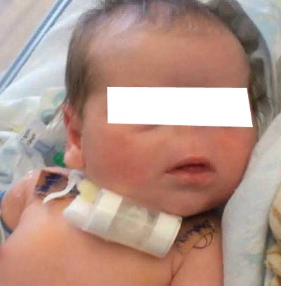 Brave little girl without a nose is born fighter - News - Emirates24|7